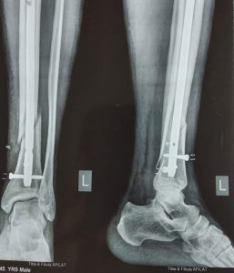 Hand Surgery in Noida, Delhi NCR | Visit OrthoVision Clinic/ Dr ...